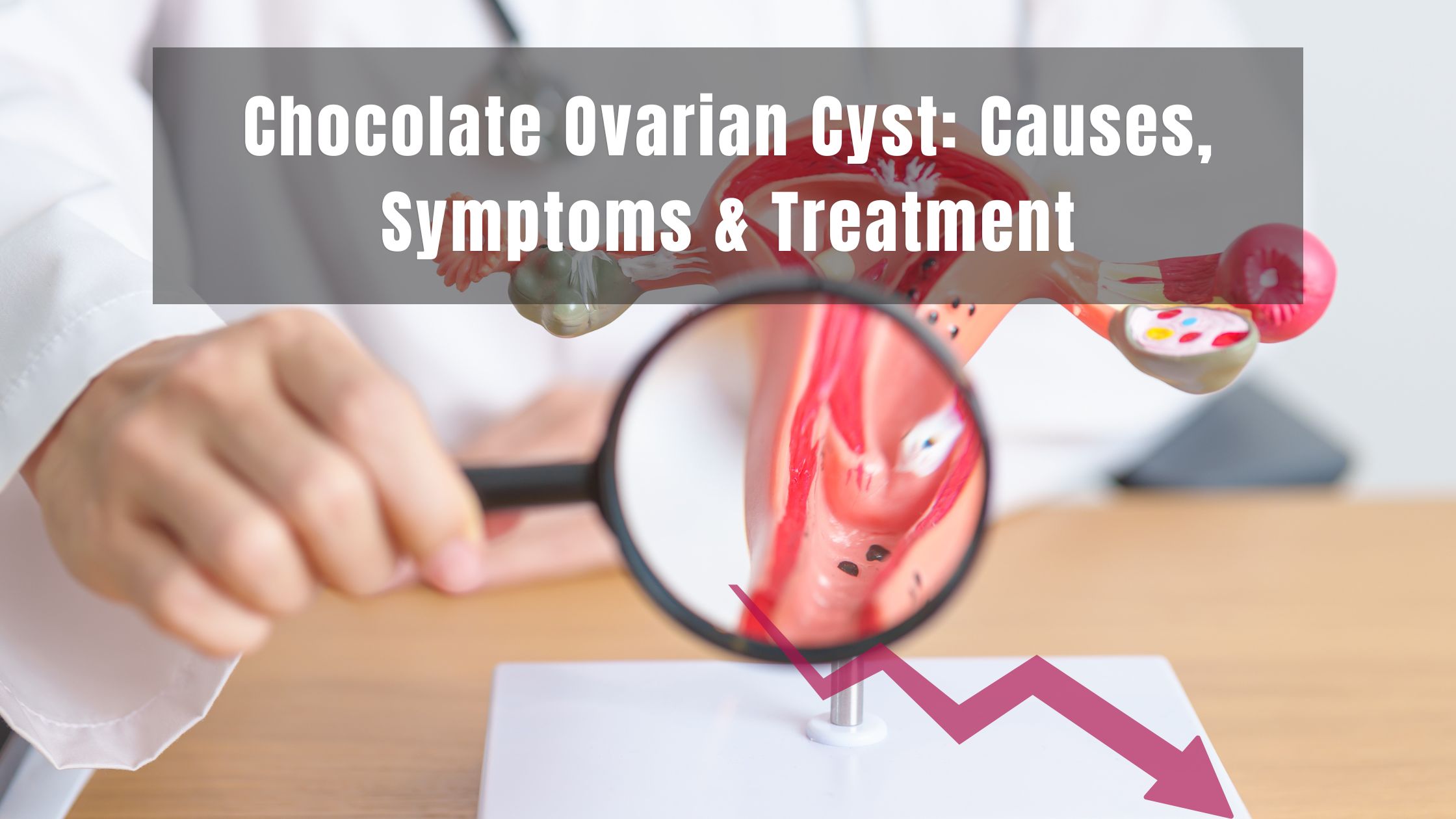 Chocolate Ovarian Cyst: Causes, Symptoms & Treatment